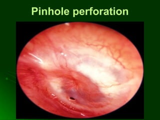 Acute Suppurative Otitis Media and its management | PPT