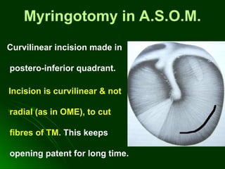 Acute Suppurative Otitis Media and its management | PPT