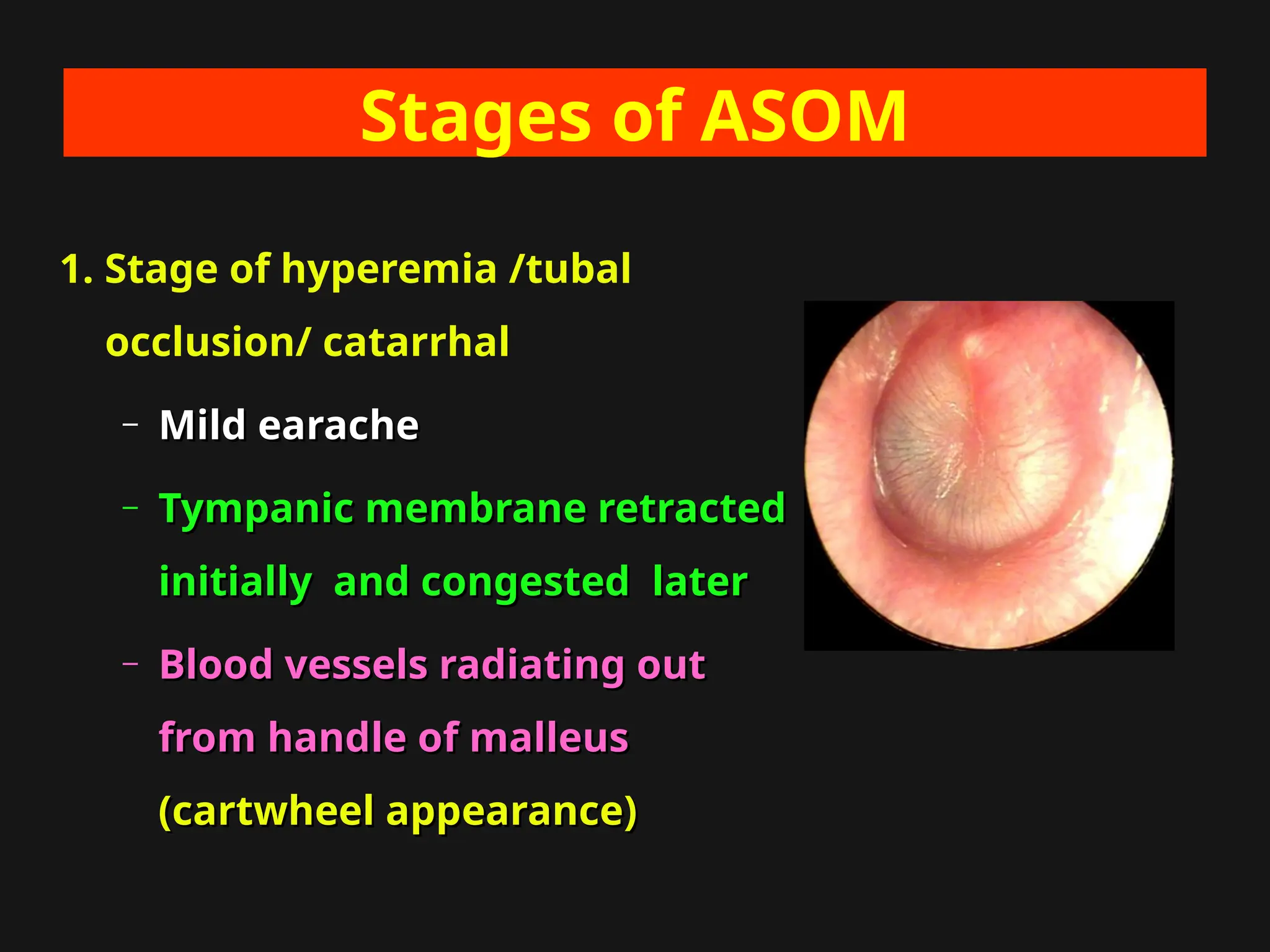 Acute Suppurative Otitis Media and acute mastoiditis KK.ppt