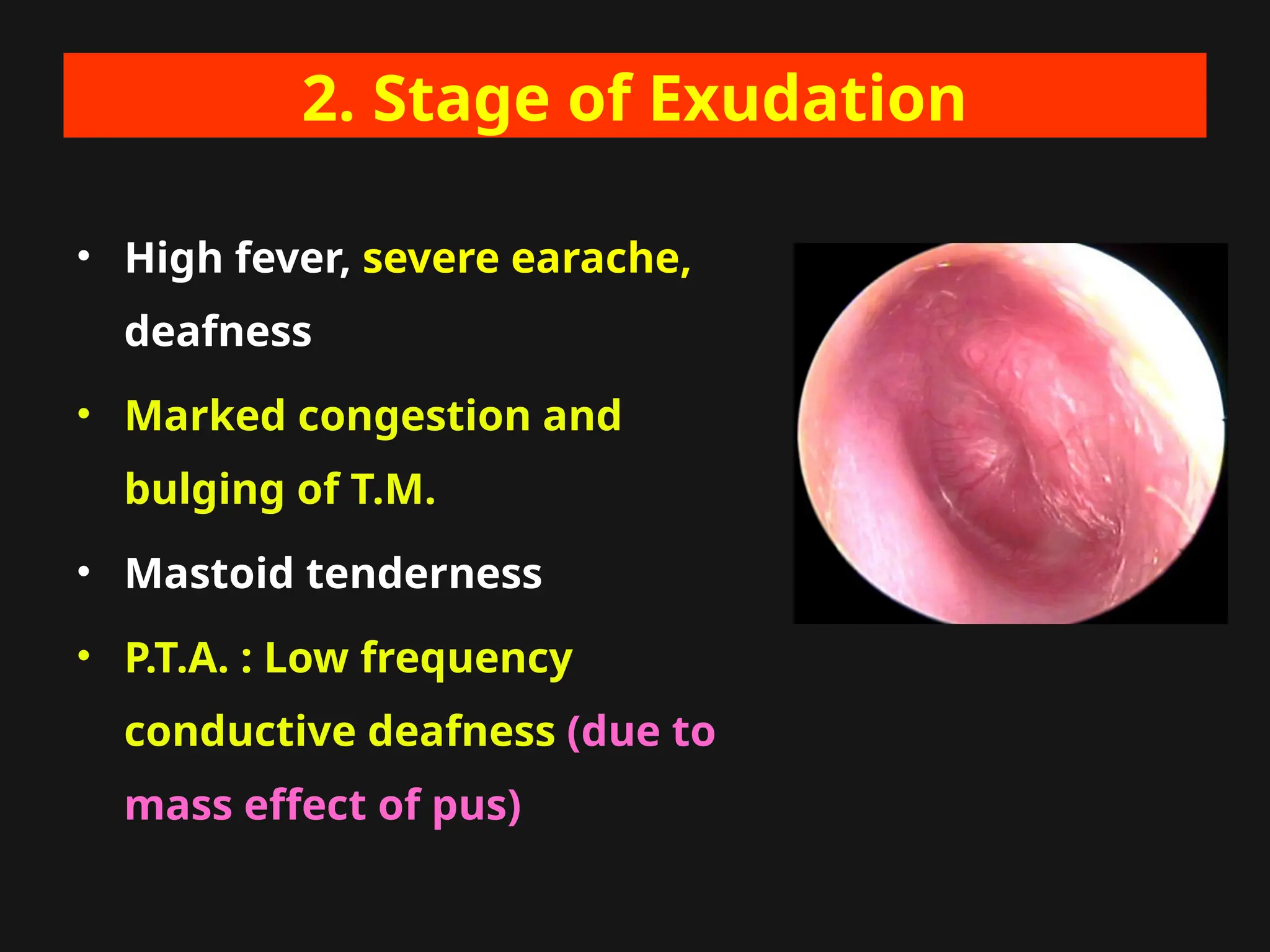 Acute Suppurative Otitis Media and acute mastoiditis KK.ppt