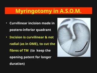 Acute Suppurative Otitis Media and acute mastoiditis KK.ppt