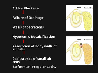 Acute Suppurative Otitis Media and acute mastoiditis KK.ppt