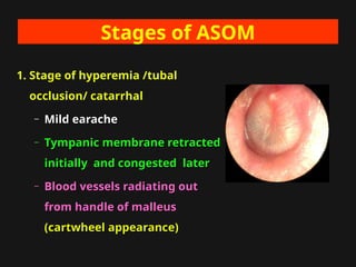 Acute Suppurative Otitis Media and acute mastoiditis KK.ppt