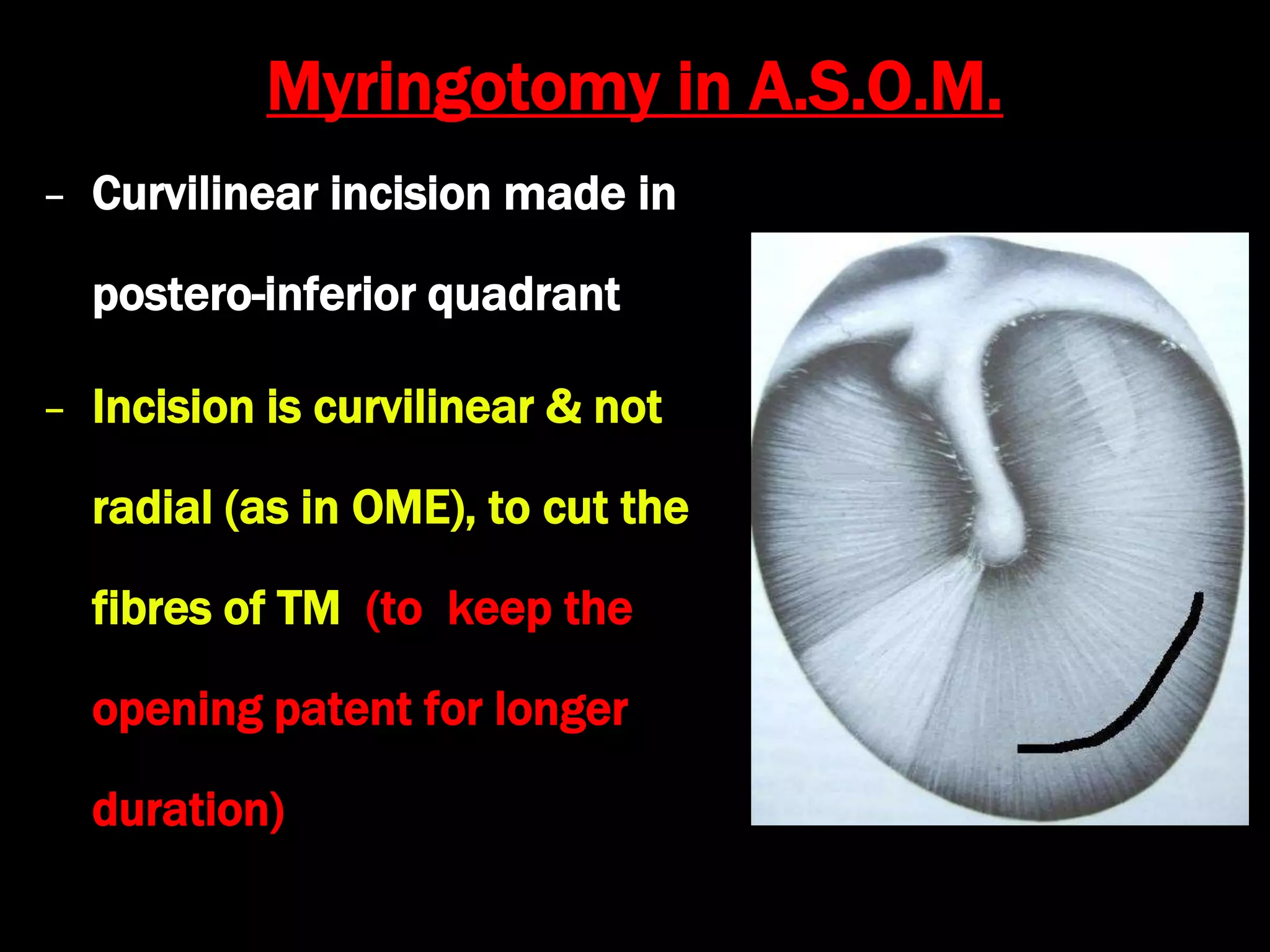 Acute suppurative otitis media and and cortical mastoidectomy | PPT