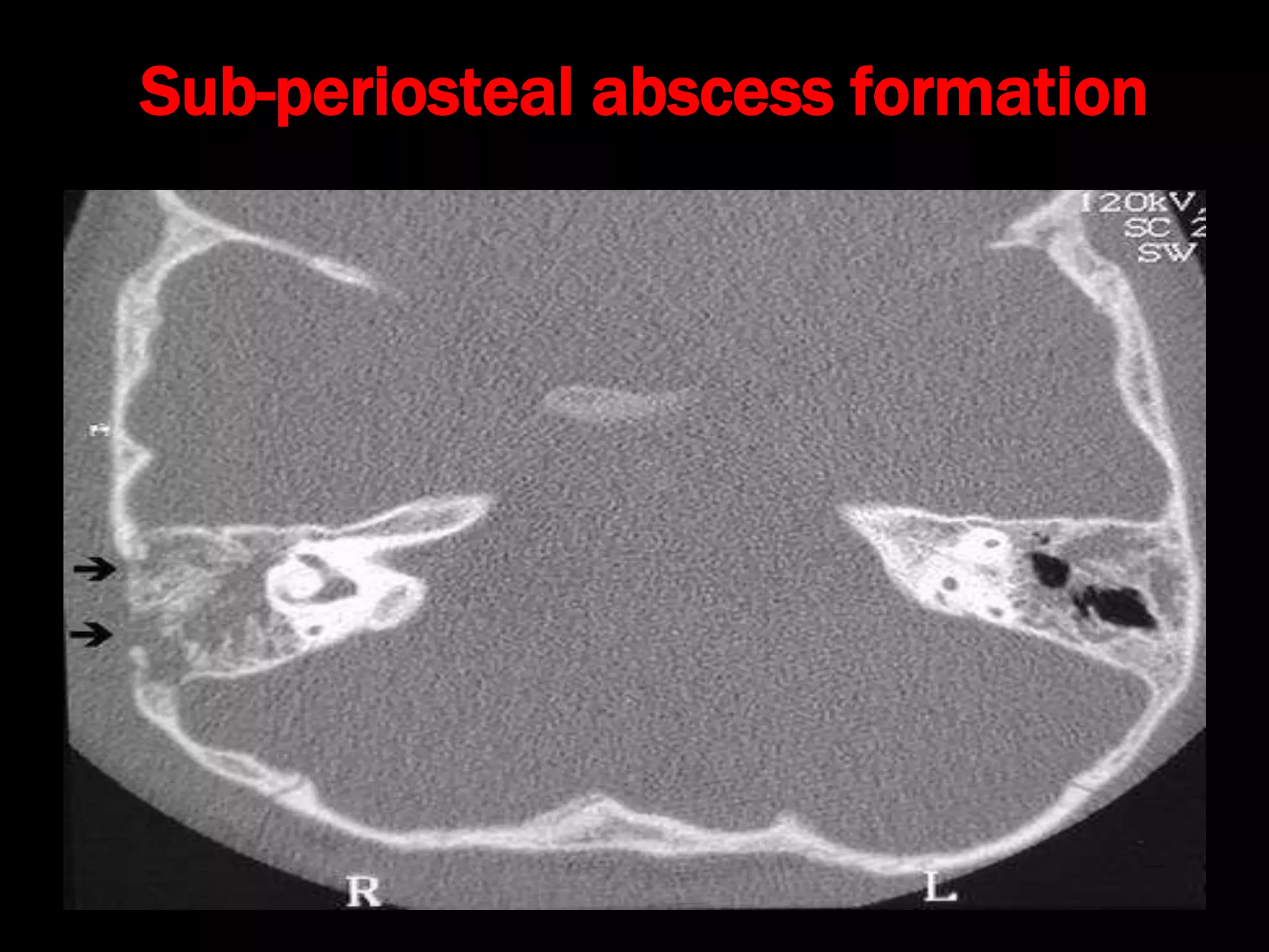 Acute suppurative otitis media and and cortical mastoidectomy | PPT ...