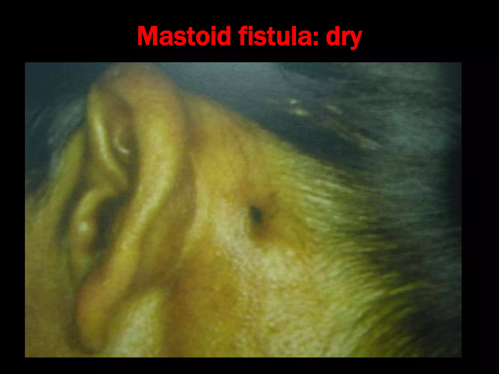 Acute suppurative otitis media and and cortical mastoidectomy | PPT