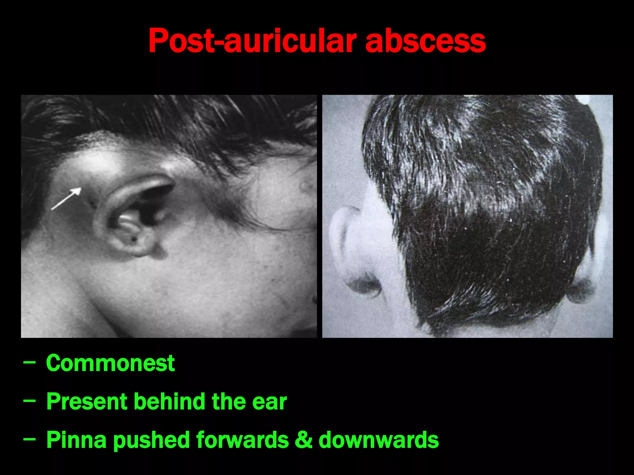 Acute suppurative otitis media and and cortical mastoidectomy | PPT