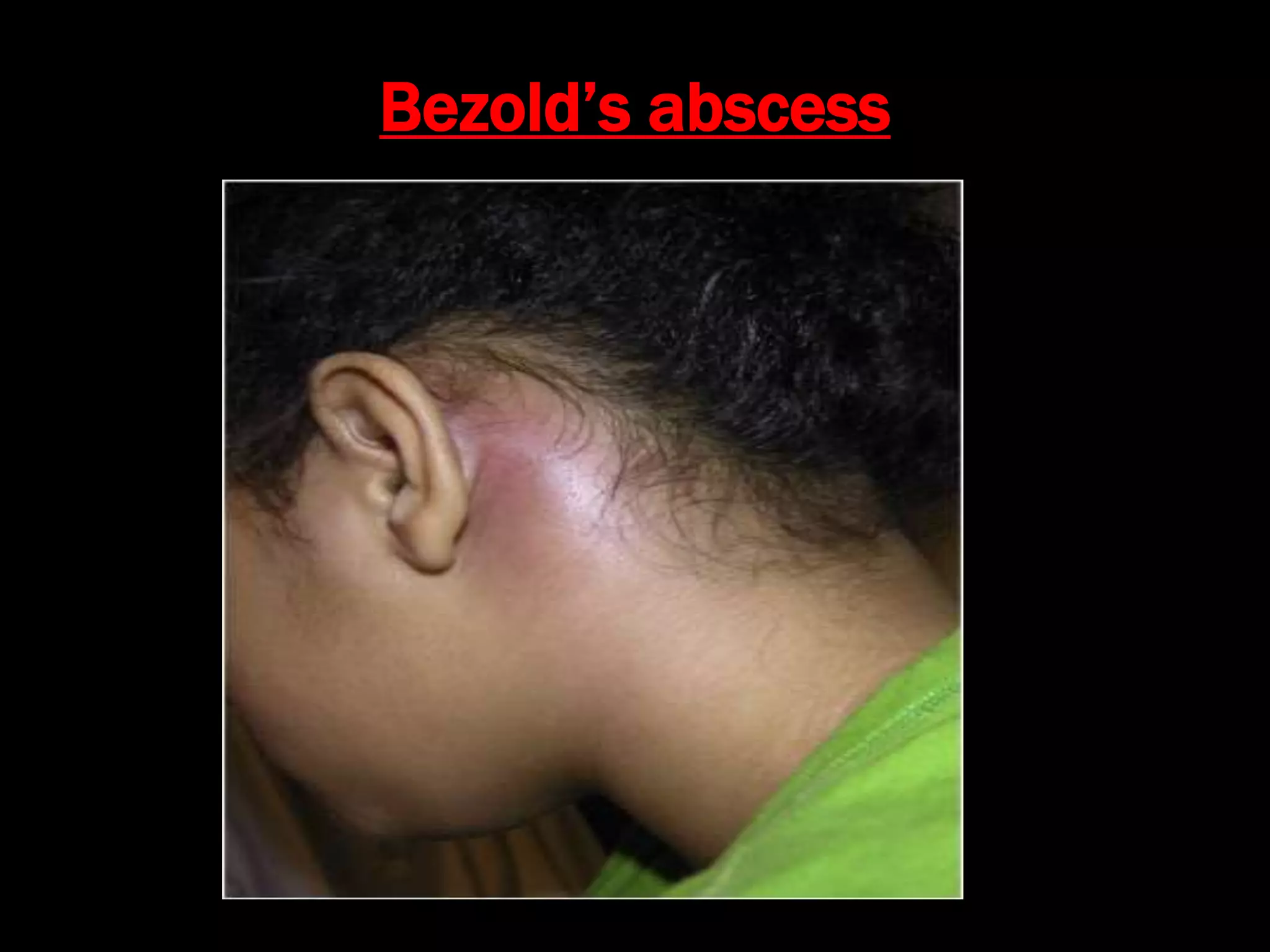 Acute suppurative otitis media and and cortical mastoidectomy | PPT