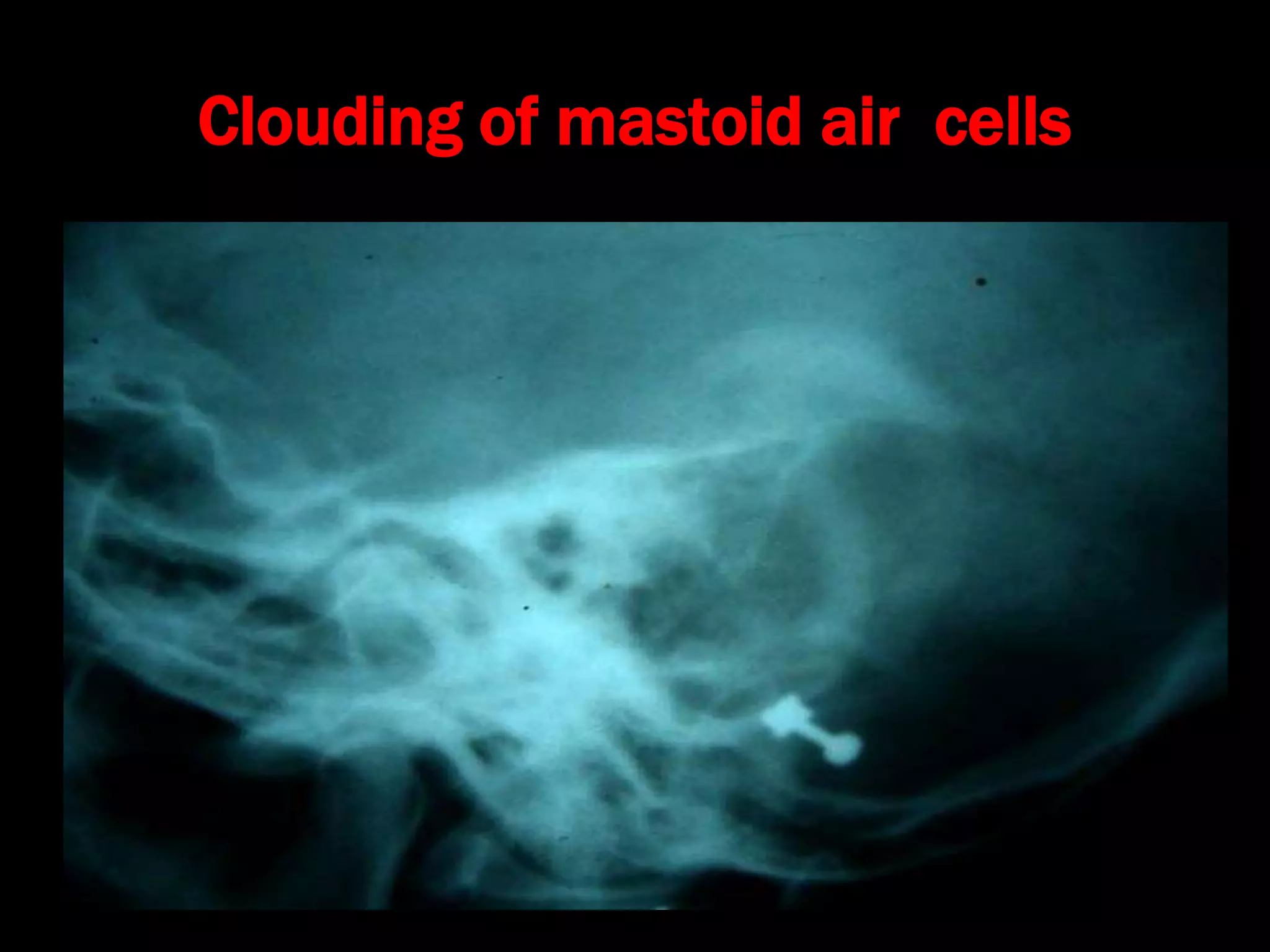 Acute suppurative otitis media and and cortical mastoidectomy | PPT