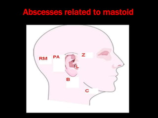 Acute suppurative otitis media and and cortical mastoidectomy | PPT