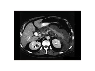 Acute Abdomen - Julie Cornish | PPT