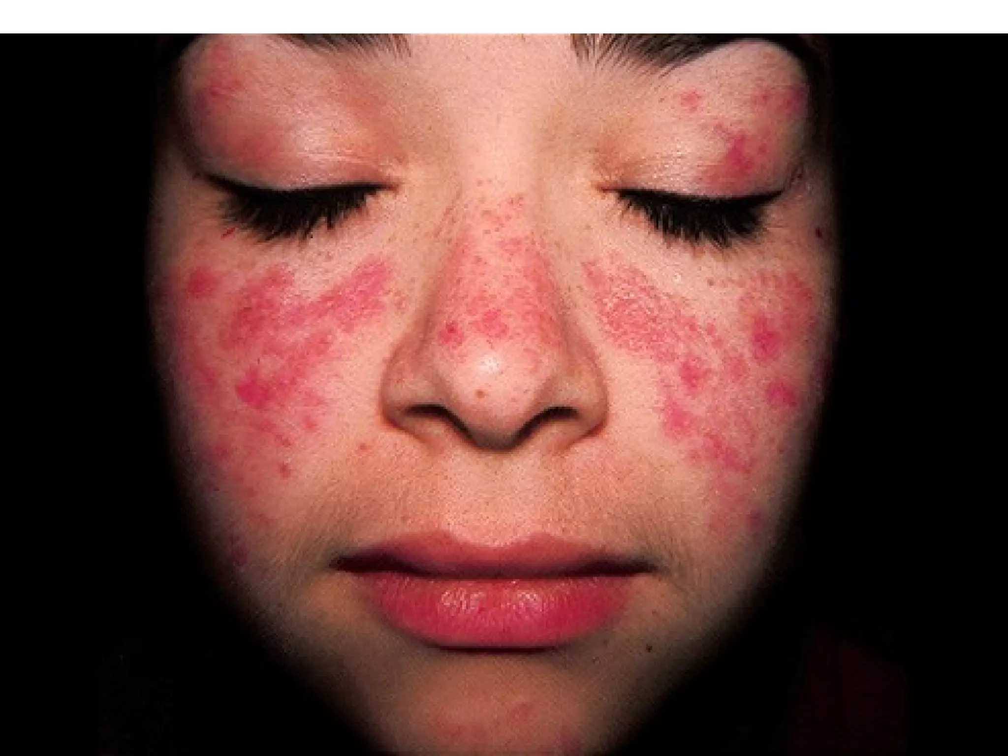 Acute systemic lupus erythematosus | PPT