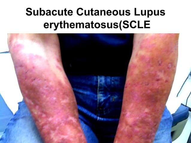 Acute systemic lupus erythematosus | PPT