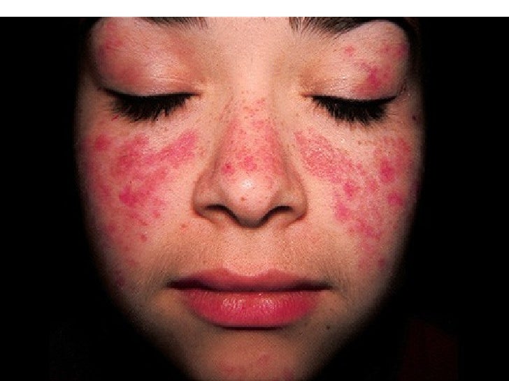 Acute systemic lupus erythematosus