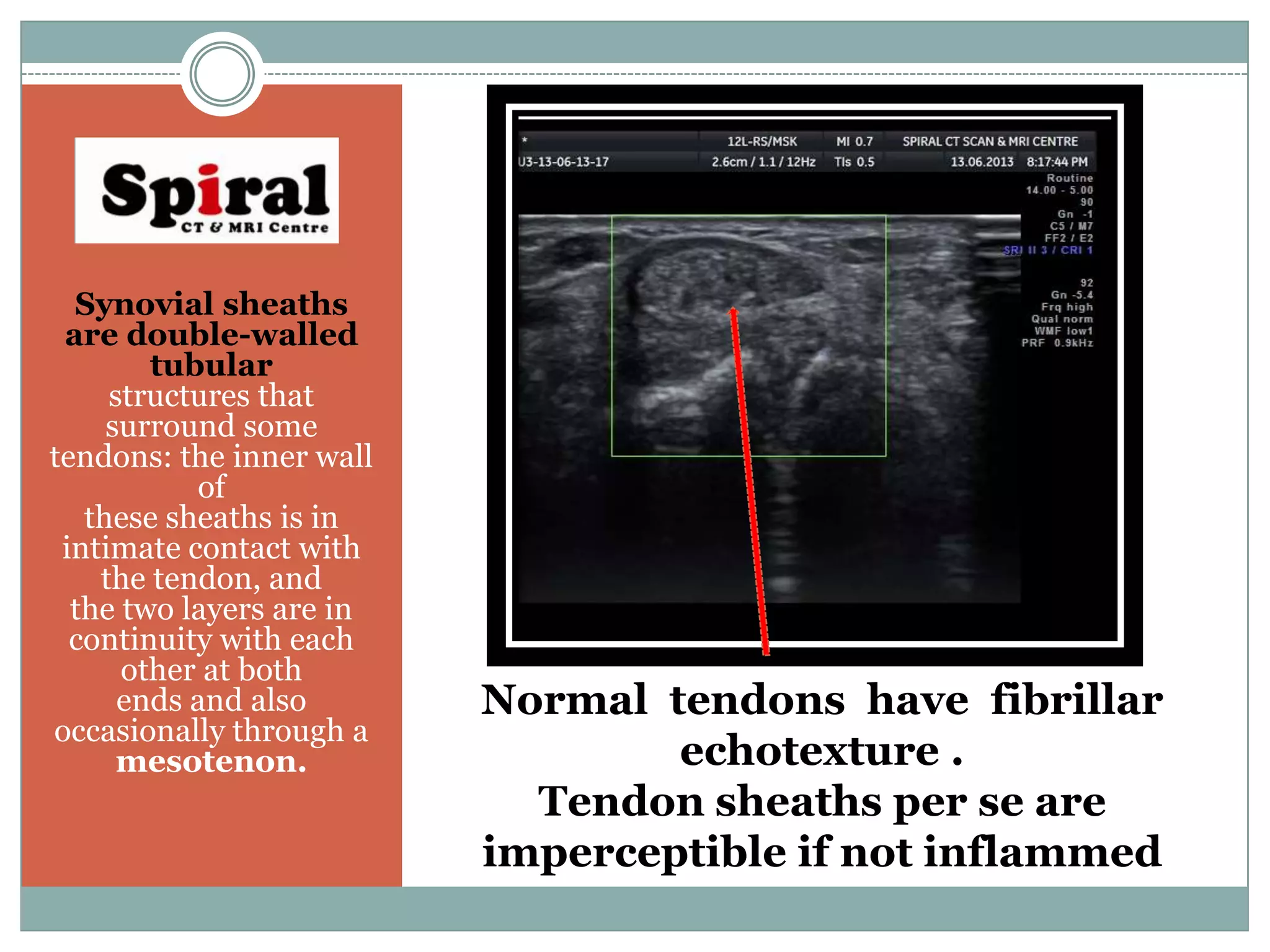 Acute tenosynovitis | PPTX