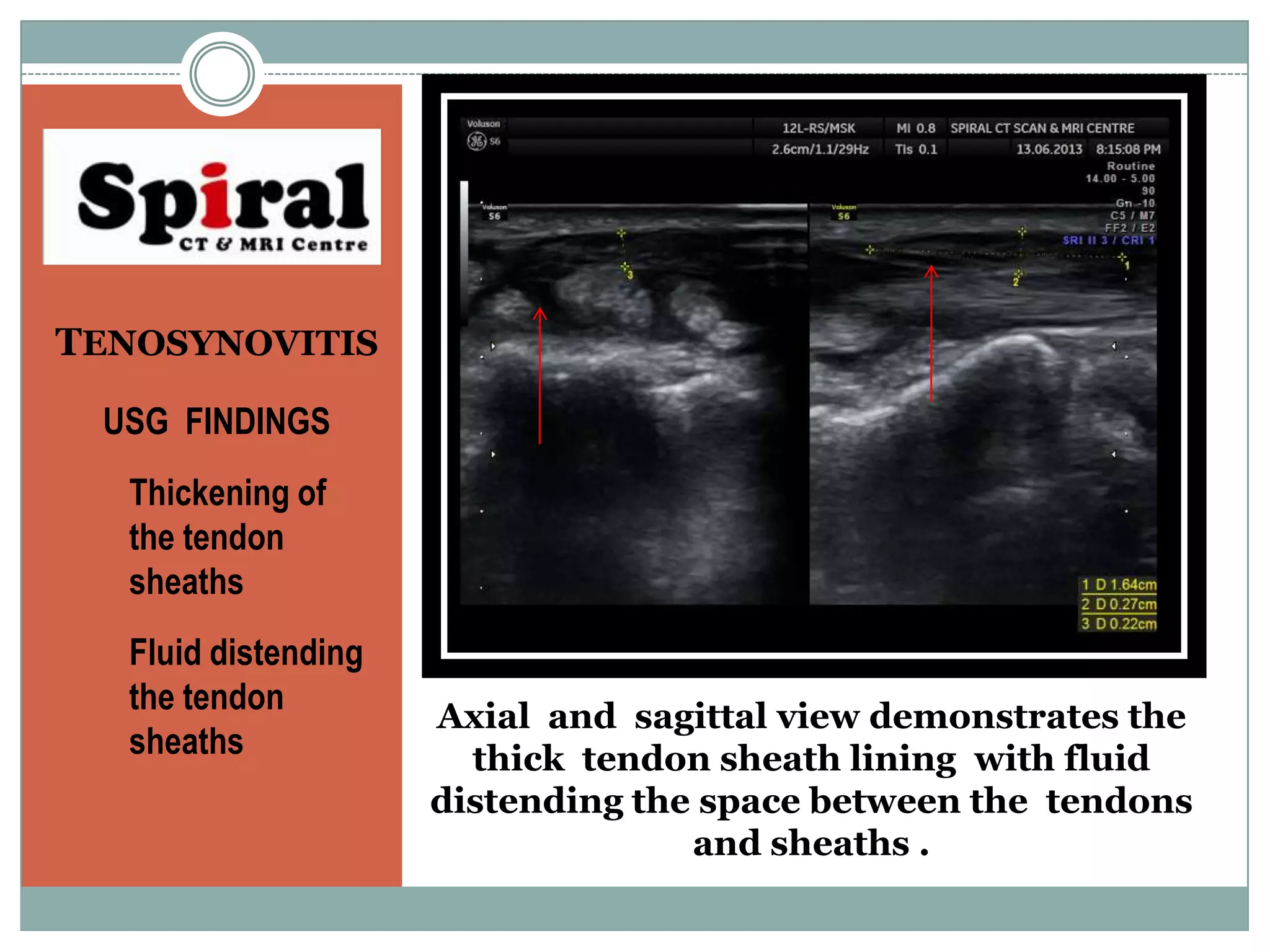 Acute tenosynovitis | PPTX