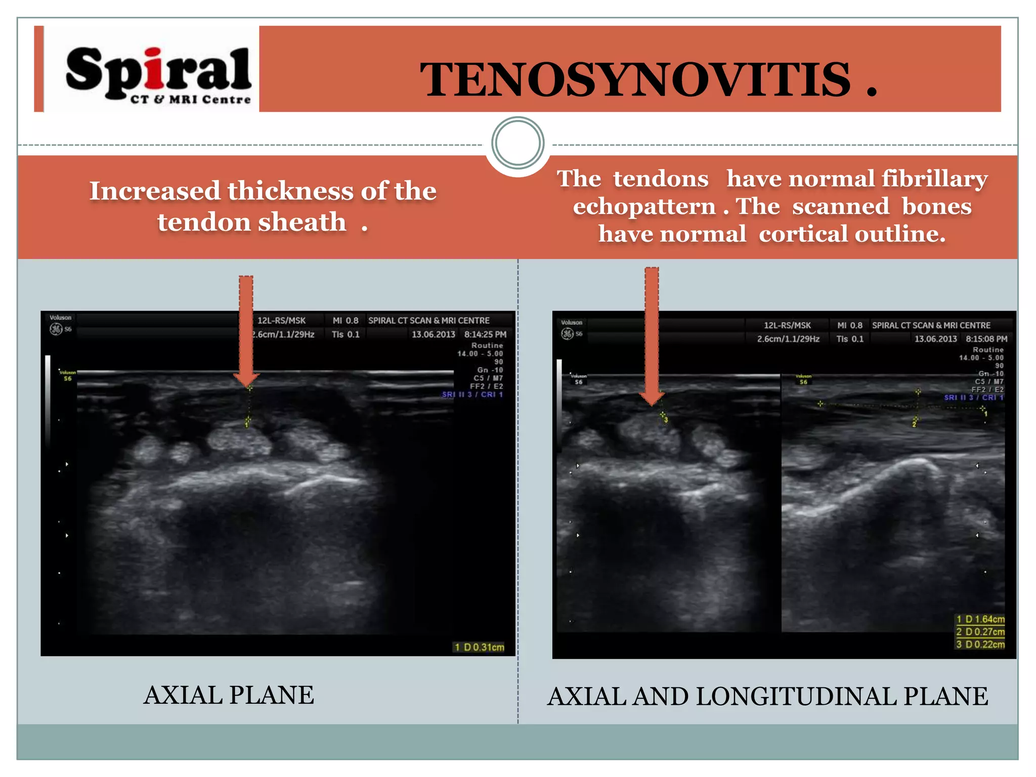 Acute tenosynovitis | PPTX