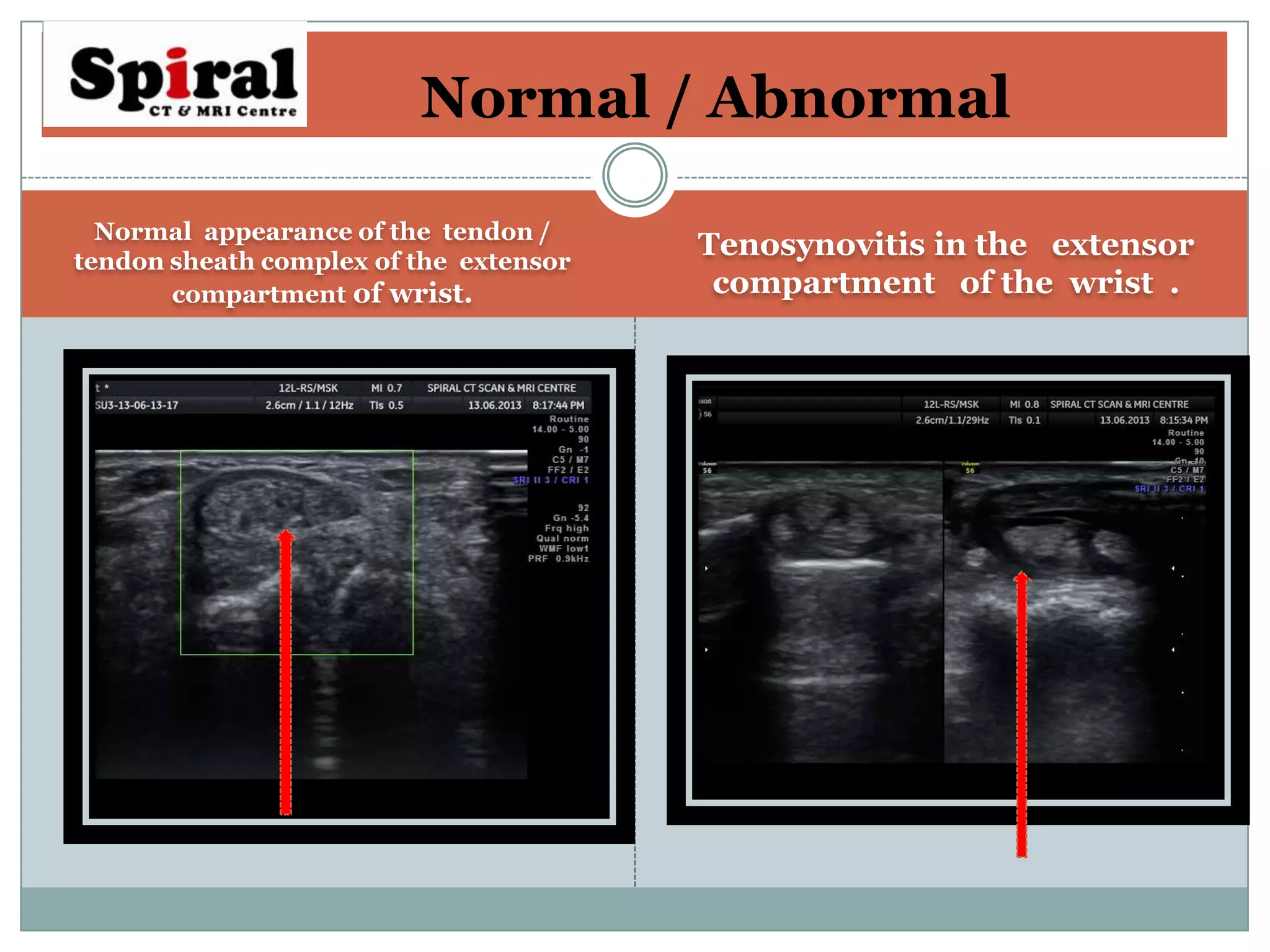 Acute tenosynovitis | PPTX