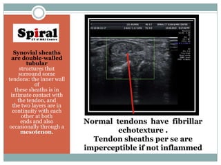 Acute tenosynovitis | PPTX
