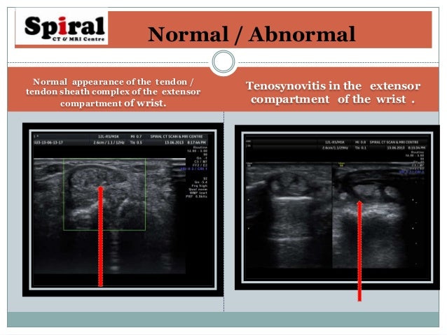 What Is Extensor Tendonitis Know Its Treatment Symptoms