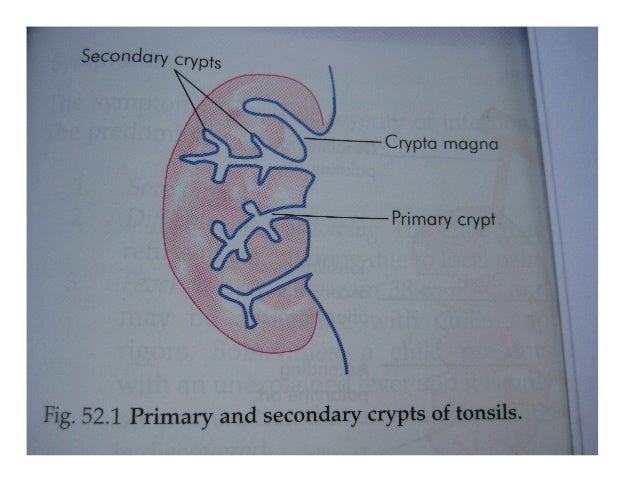 Tonsillar Crypts Infection