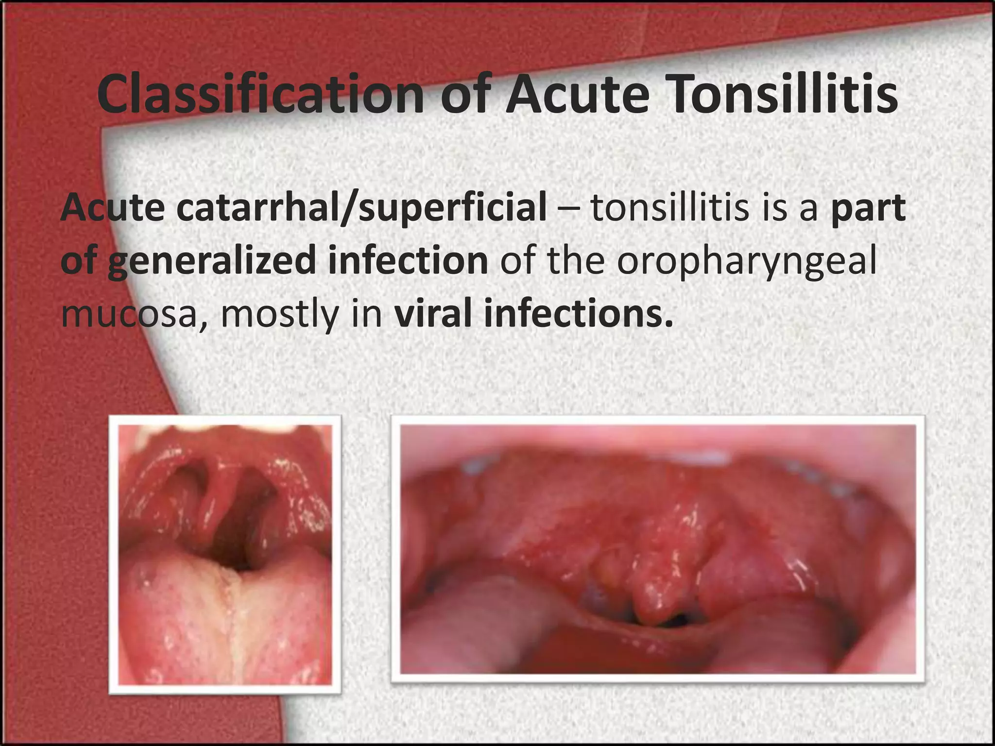 Acute tonsillitis | PPTX | Ear, Nose and Throat Conditions | Diseases ...