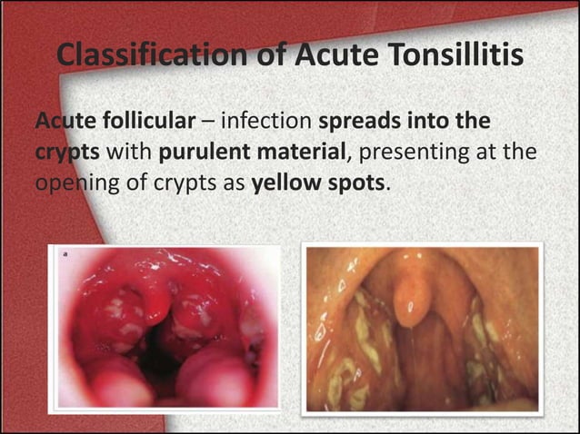 Acute tonsillitis | PPTX | Ear, Nose and Throat Conditions | Diseases and Conditions