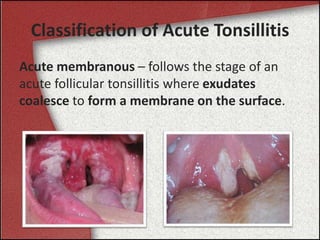Acute tonsillitis | PPTX