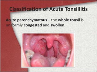 Acute tonsillitis | PPTX