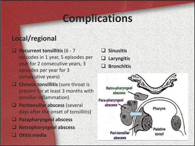 Acute tonsillitis | PPTX | Ear, Nose and Throat Conditions | Diseases ...