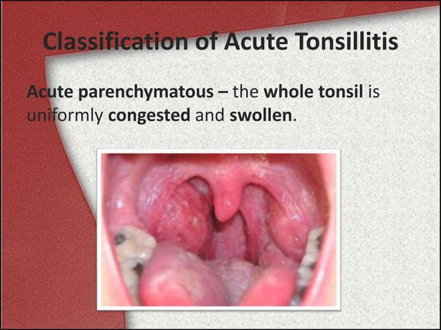 Acute tonsillitis | PPT