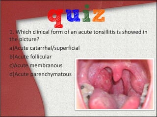 Acute Catarrhal Tonsillitis