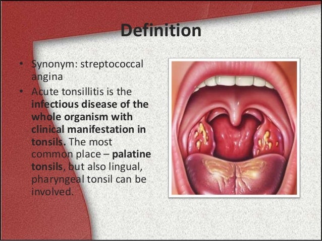 Acute tonsillitis