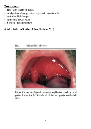 Acute tonsillitis | PDF