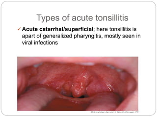Acute tonsillitis | PPT