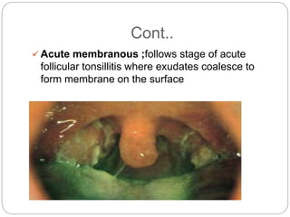 Acute tonsillitis | PPTX