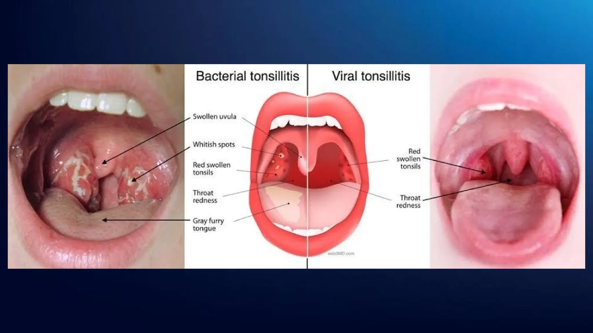 ACUTE TONSILLITIS 35.pptx ACUTE TONSILLITIS 35.pptx