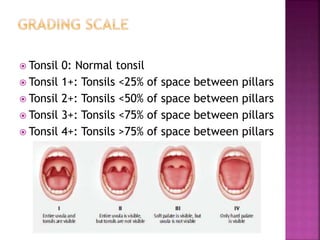 Acute tonsillopharyngitis | PPTX