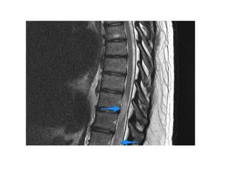 Acute transverse myelitis | PPTX
