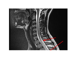 Acute transverse myelitis | PPTX