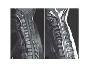 Acute transverse myelitis | PPTX