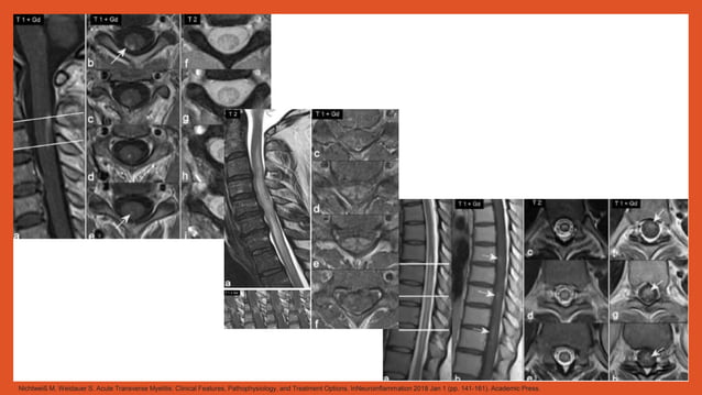 Acute Transverse Myelitis | PPTX