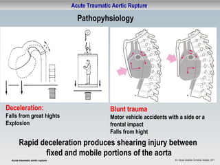 Acute traumatic aortic rupture | PPT