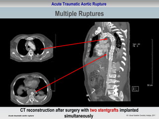 Traumatic Aortic Rupture