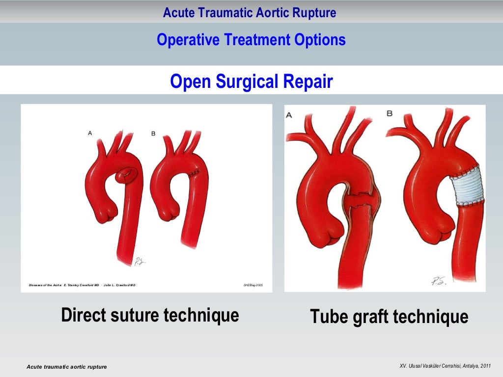 Acute traumatic aortic rupture