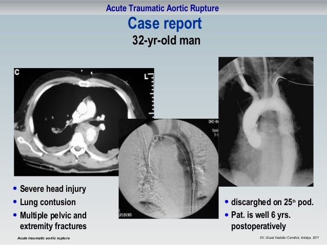 Acute traumatic aortic rupture