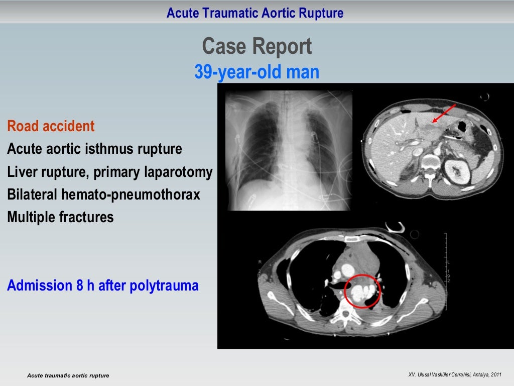 Acute traumatic aortic rupture