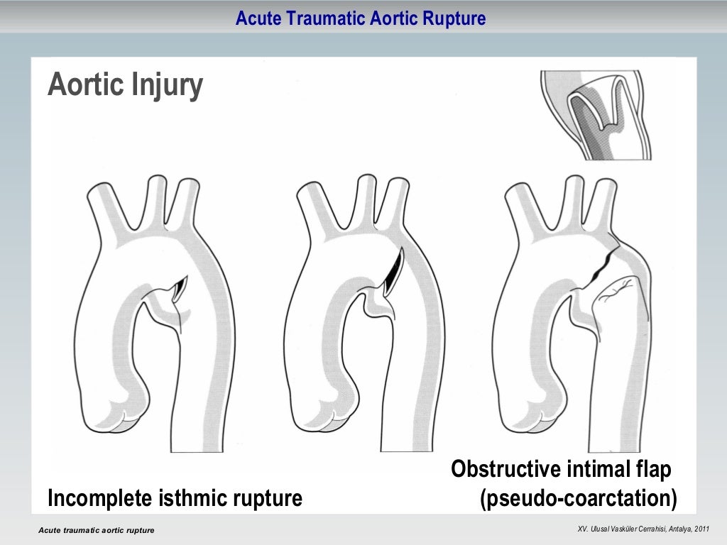 Acute traumatic aortic rupture