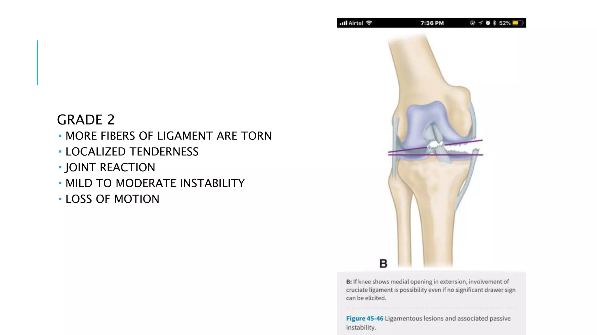 Acute traumatic lesions of ligaments of knee | PPTX