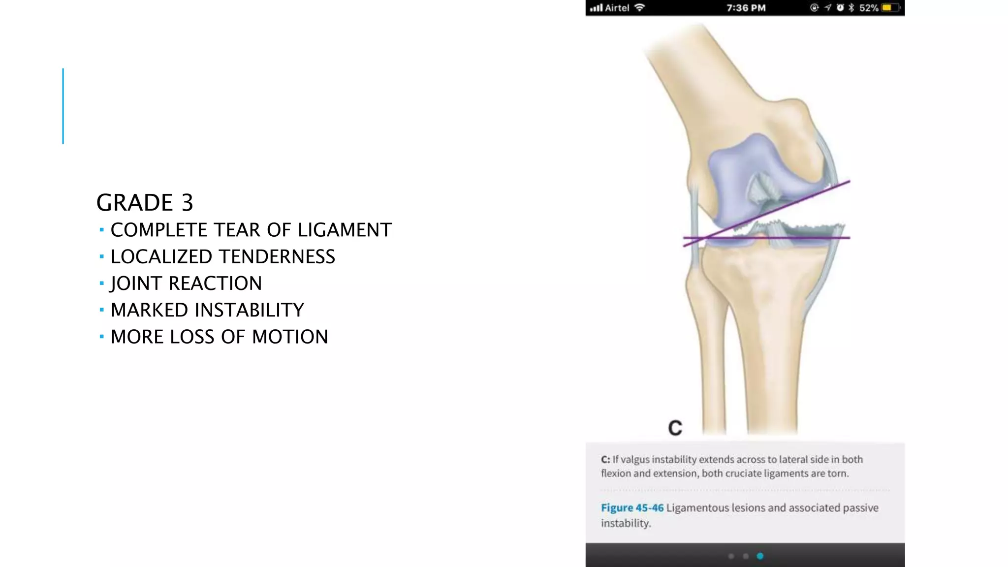 Acute traumatic lesions of ligaments of knee | PPTX